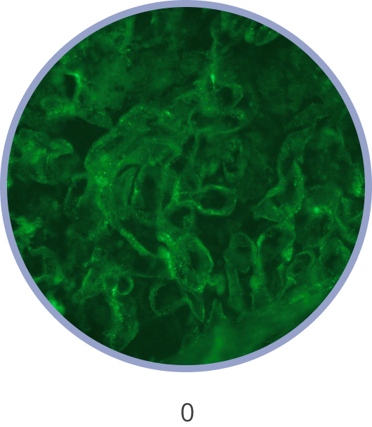 What is C3G & Primary IC-MPGN | EMPAVELI® (pegcetacoplan)